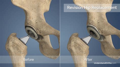 Revision Hip Replacement Understandortho™
