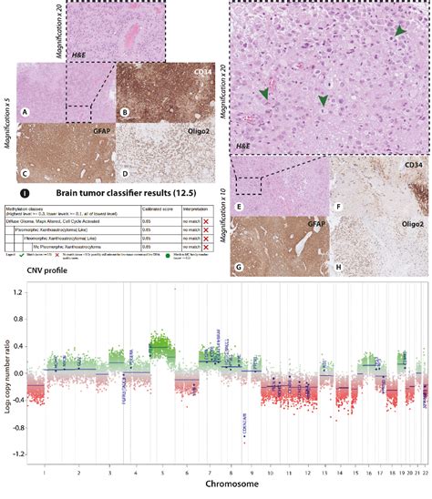 Figure 1 From Pdp Type Brain Tumor In Association With Multiple Endocrine Neoplasia Type 1
