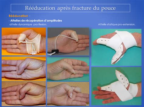 Rééducation Après Fracture De Phalange Du Pouce Denis Gerlac Rééducation Et Orthèse De La