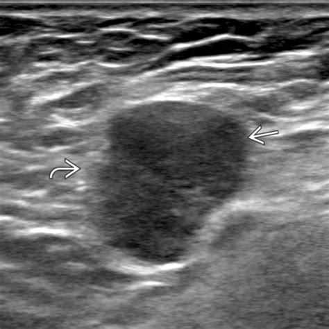 Lymph Node Abnormality Radiology Key