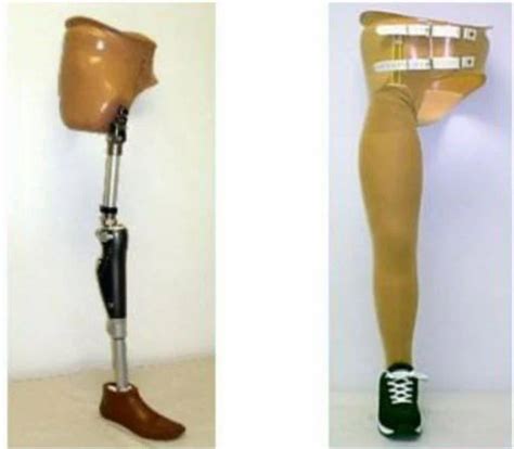 Hip Disarticulation Prostheses At ₹ 110000 Piece Bipolar Prosthesis