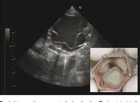 Figure 1 From A New Treatment Option For Pulmonary Valvar Insufficiency