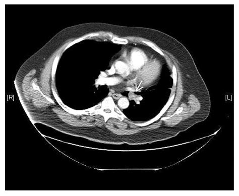 Computed Tomography Image Showing A 1 4 Cm Soft Tissue Nodular Density