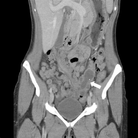 Axial And Coronal Ct Images Showing Intussusception With The Appendix