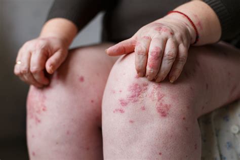 The Connection Between Multiple Sclerosis And Psoriasis Dermatology Times