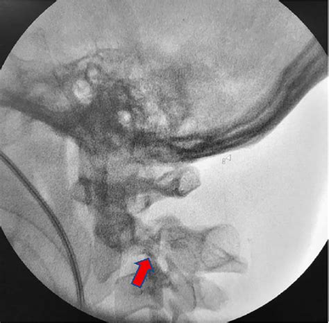 Patient 4 Pre Operative Lateral Cervical X Ray Showing Bilateral