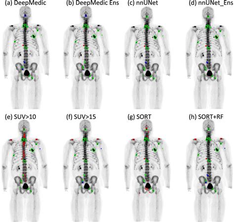 Qualitative Comparison Of Detection Performancefor An Example Patient Download Scientific