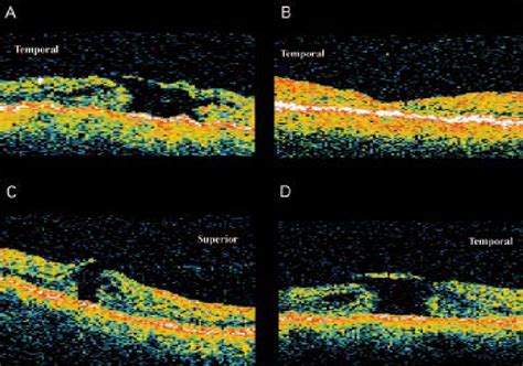 Case 2 Horizontal Oct Scan Through Right Fovea With Stage 3 Macular