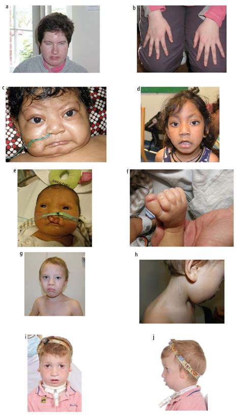 Sindrome De Digeorge