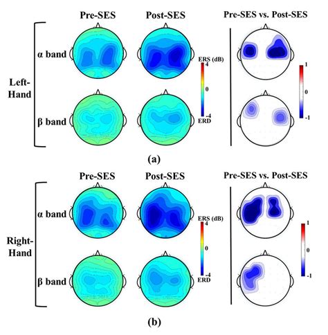 Comparison Of Topographical Activation Patterns Between Pre Ses Block