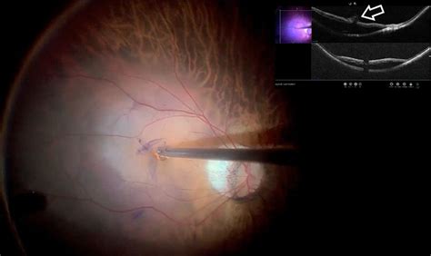 Epiretinal Membrane Oct Retina