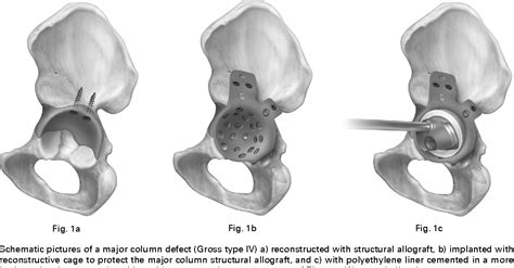 Types Of Acetabular Cups At Jasper Gunson Blog