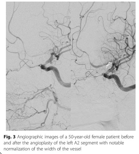 Abbreviations Aca Anterior Cerebral Artery Acm Middle Cerebral Download Scientific Diagram