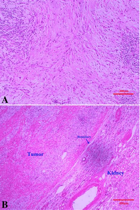A The Tumor Disclosed Intersecting Fascicles Of Fibroblastic Cells Download Scientific Diagram