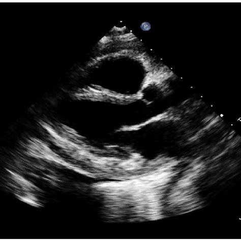 Echocardiography Shows Markedly Thickened Pericardium And Abnormal Soft Download Scientific