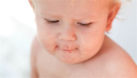 Treating Teething Rash Advice From Experts