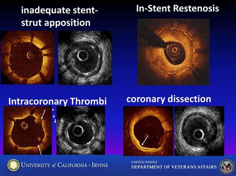 Forget Ivus And Oct Everyone Should Be Using Ffr Ppt Download