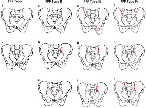 What Is The Long Term Clinical Outcome After Fragility Fractures Of The