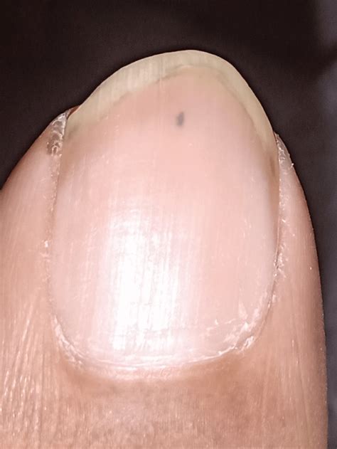 I Noticed This Black Spot On My Toe Nail Yesterday Does It Seem Like A
