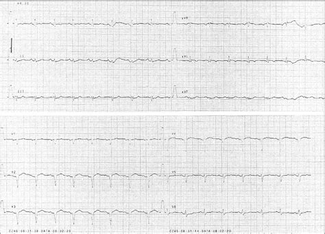 Figure 1 From Fragmented Qrs And Arrhythmic Events In Patients With