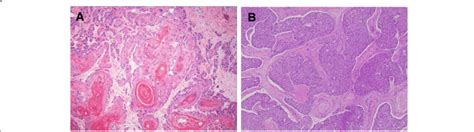 Histological Characteristics Of Hpv Positive And Hpv Negative Opscc