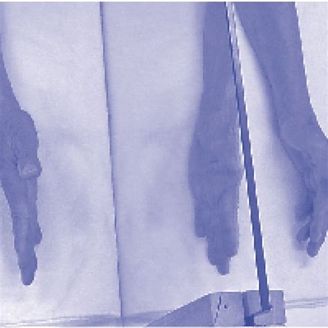 Patient With Brachial Plexus Lesion Download Scientific Diagram