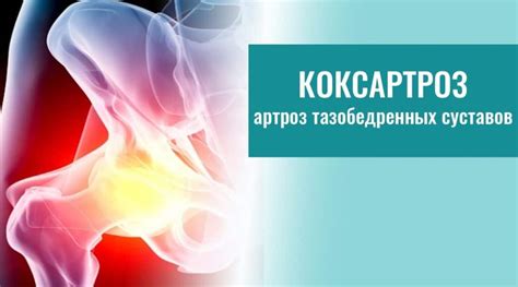 Что такое коксартроз: термины, этиология и патогенез