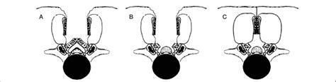 Illustration Of The Surgical Technique A Splitting Of The Spinous Download Scientific Diagram