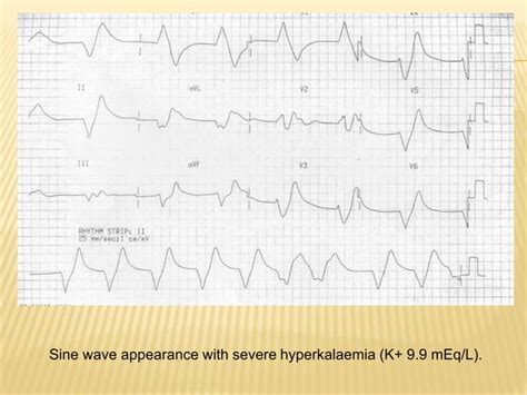 Hyperkalemia Ppt