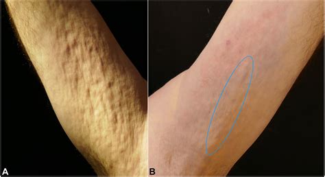 Eosinophilic Fasciitis Clinical Presentation History