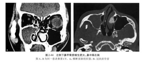 鼻腔、鼻窦正常解剖、解剖变异及影像学表现 知乎
