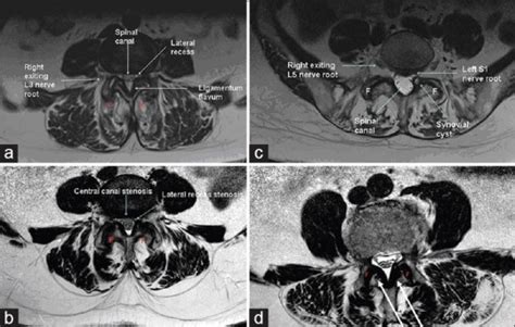 Radiological And Radionuclide Imaging Of Degenerative Disease Of The Facet Joints Pmc