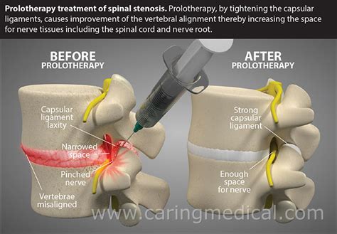 Spinal Stenosis Spinal Stenosis Symptoms And Non Surgical Treatment