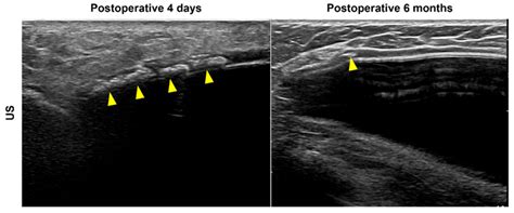High Resolution Ultrasound Dermal Imaging For Assessing