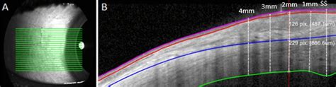 Anterior Eye Oct Imaging Volume Scan 21 Lines Captured A