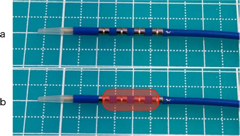 Recanalization Using A Temperature‐controlled Rf Catheter For Ingrowth