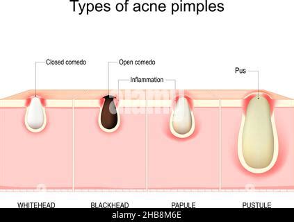 Types Of Acne Skin Inflammation Pimples Boils Whitehead Closed