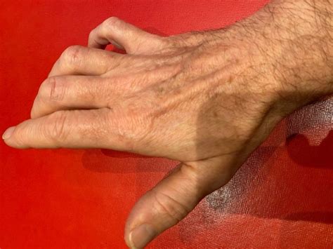 Compression Du Nerf Ulnaire Docteur Faivre Chirurgie De La Main