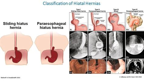 Classification Of Hiatal Hernias • Sliding Hiatus Hernia