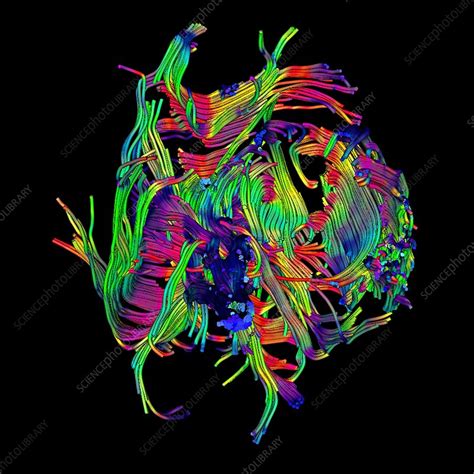 Brain Tumour Dti Scan Stock Image C006 8371 Science Photo Library