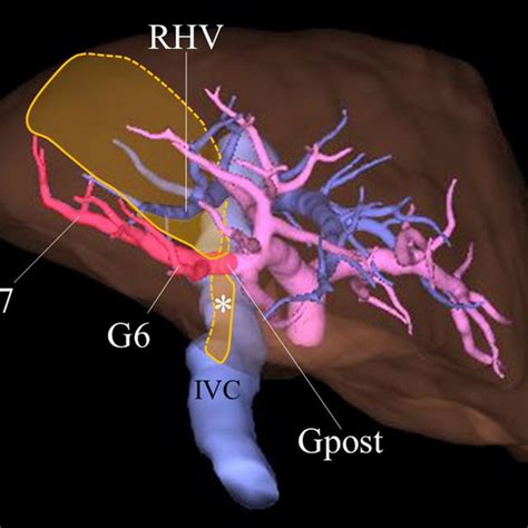 Pure Laparoscopic Right Posterior Sectionectomy Using The Caudate Lobe First Approach Request Pdf