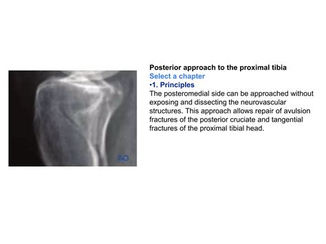 Proximal Tibia Approach Pptx