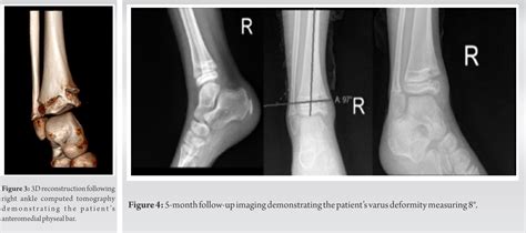 Spontaneous Resolution Of Pediatric Varus Ankle Deformity A Case Report Journal Of
