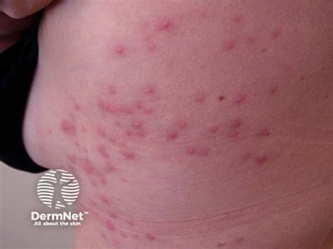 Pseudomonas Folliculitis A Bacterial Folliculitis That