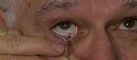 A Topical Ocular Ring Designed To Replace Glaucoma Eye Drops