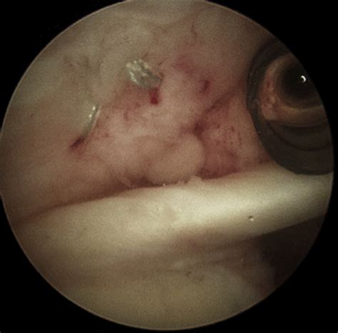 View From Inside Joint After Loop Of Nonabsorbable Suture Has Been Download Scientific Diagram