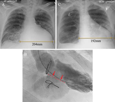 Pseudoaneurysm Red Arrow Panels A And C Improvement In Cardiac Download Scientific