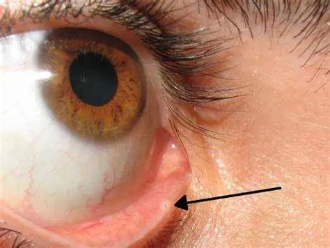 What Causes Infected Tear Duct
