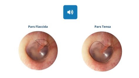 Copy V1 2 Pars Flaccida And Tensa Genially