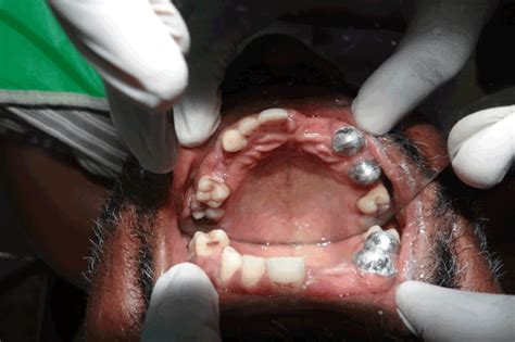 Coping Retained Removable Partial Denture An Alternative To Fixed